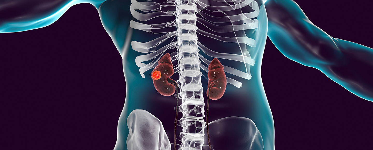 Developing Drug-Free Protection for Transplanted Kidneys - NPRC